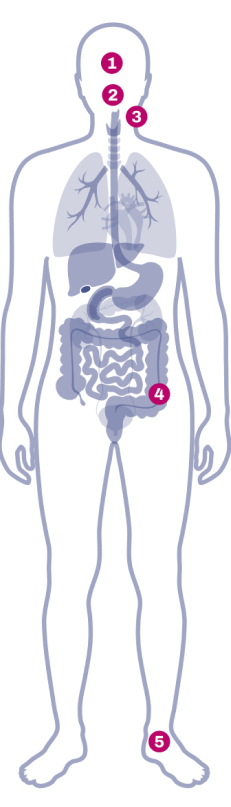Human silhouette illustrating the symptoms of acromegaly and other ...